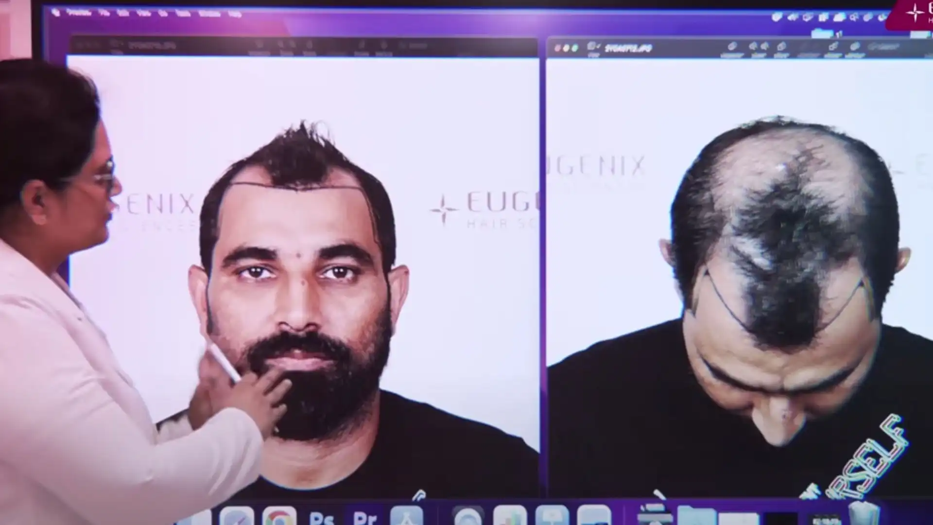 Shami Undergoes Hair Transplant; Fans Troll Rohit Sharma Over It ...